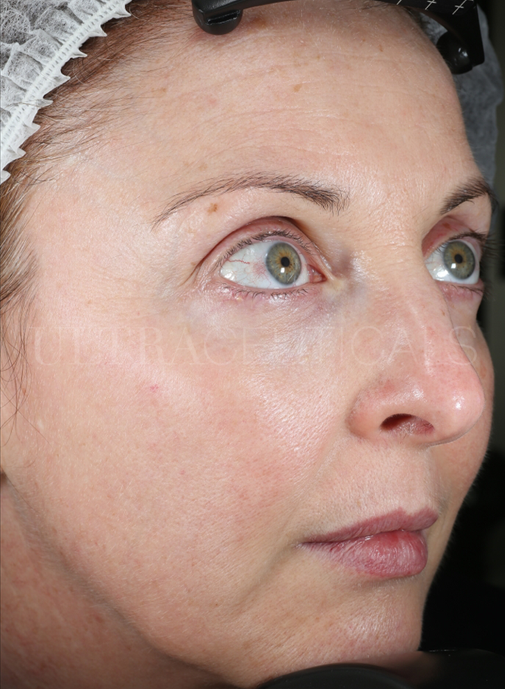 Ultra A Perfecting Intense Booster Online – Ultraceuticals AU