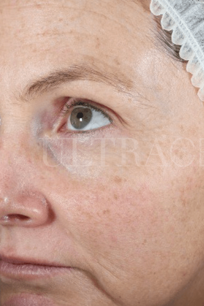 Ultra A Perfecting Intense Booster – Ultraceuticals AU