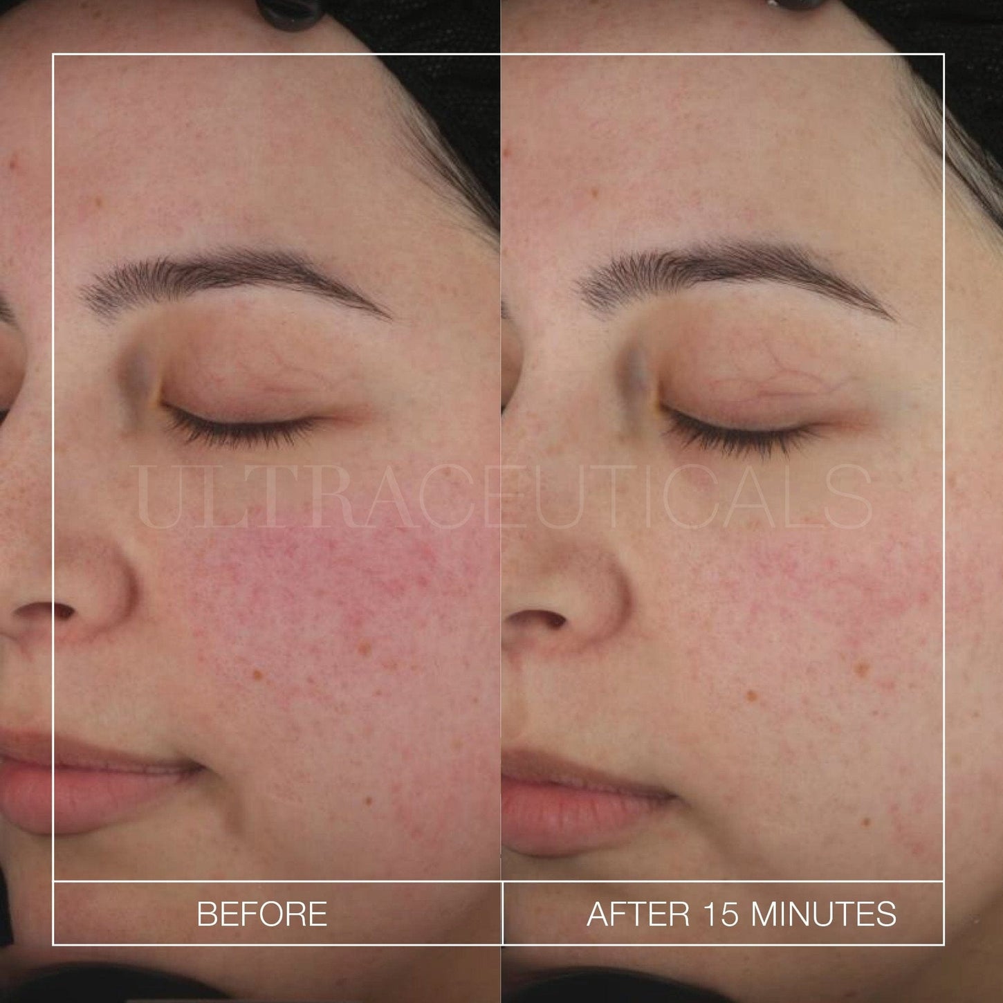 Ultra B² Recovery Cream Online – Ultraceuticals AU